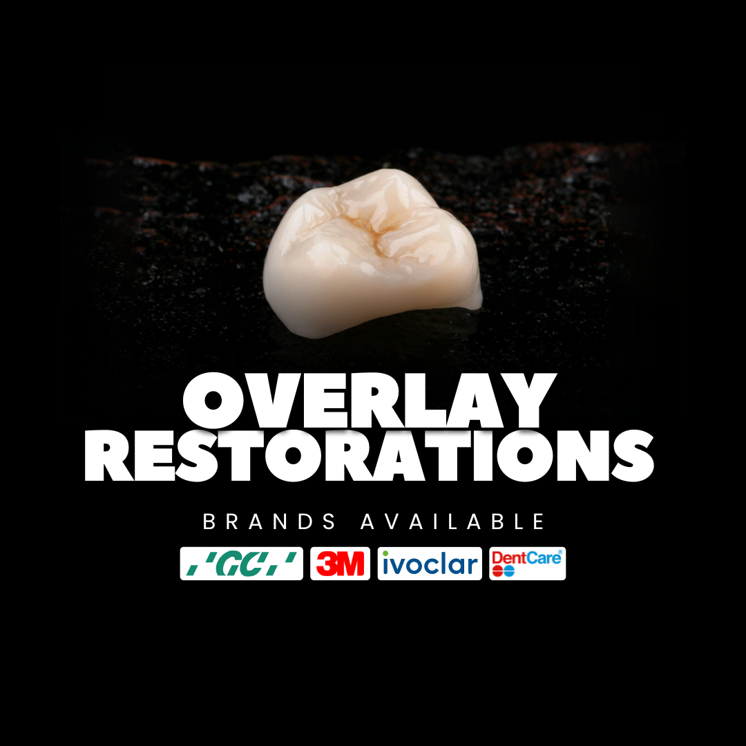 The Ultimate Guide to Overlay Restorations in Kochi (2026): Why Choose ...